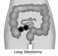 Loop/End Ileostomy