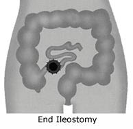 Loop Ileostomy